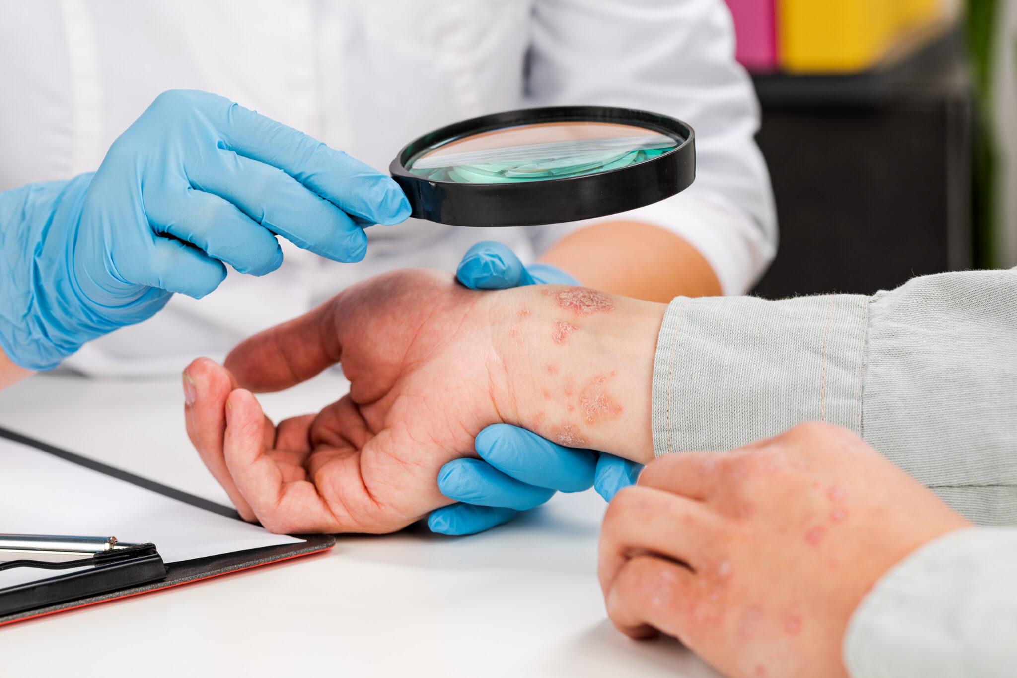 Skin infections - Tinea , scabies, boils, Herpes etc - CURA Skin, Hair ...