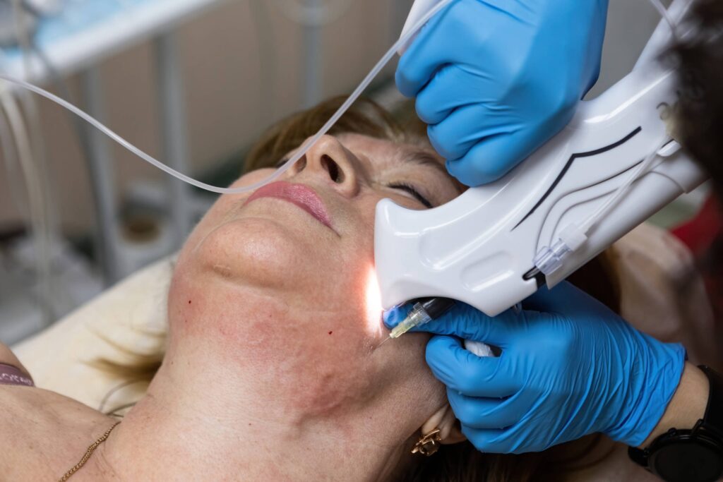 Laser - For Pigmentation, Skin Rejuvenation and open pore reduction ...