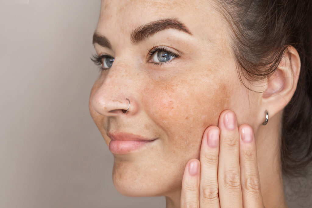 Pigmentary disorders and Melasma - CURA Skin, Hair & Laser Clinic